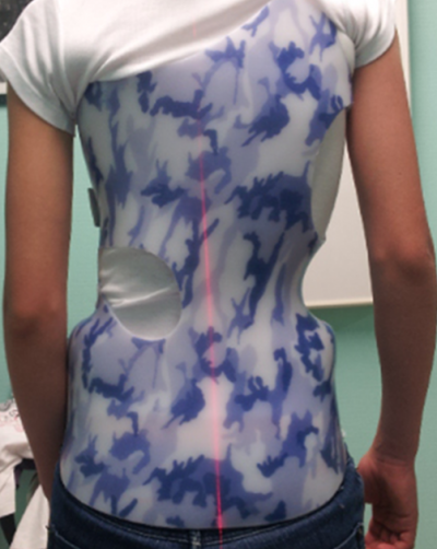 Corset de scoliose – Orthopedic'Mans